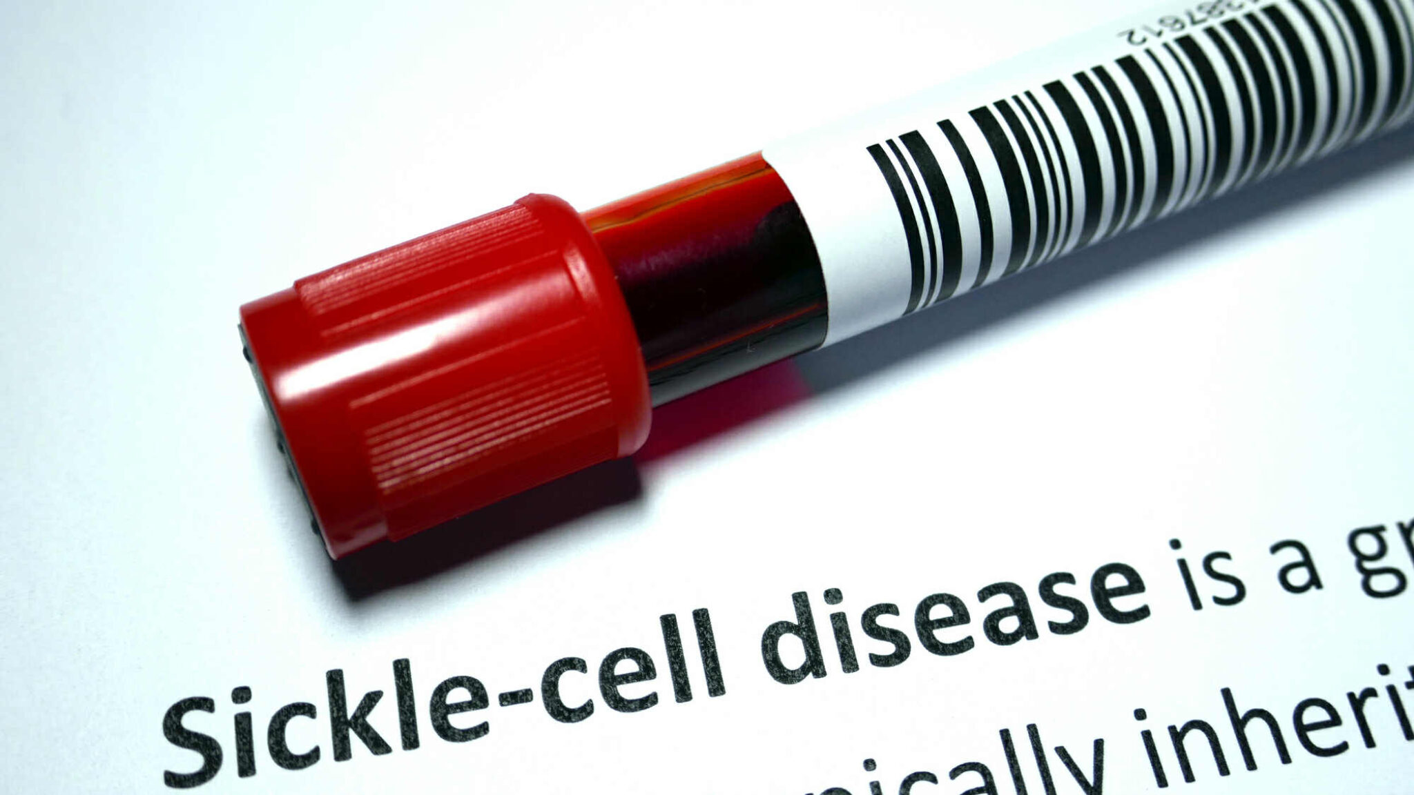 Sickle cell disease: What you need to know about SCD | Cebu Daily News